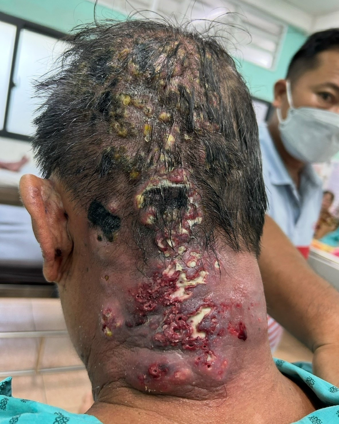 Ho Chi Minh City: Severe infection due to self-treating shingles by ...