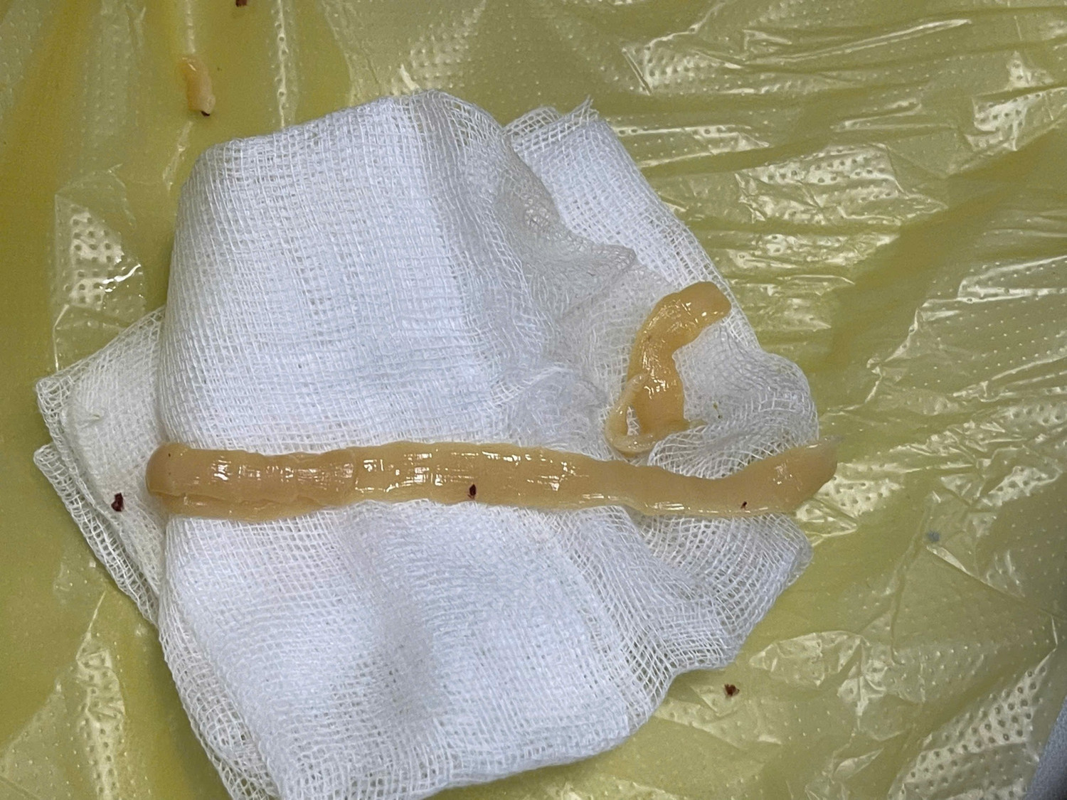 Authorities removed a nearly one-meter-long tapeworm from the colon of ...