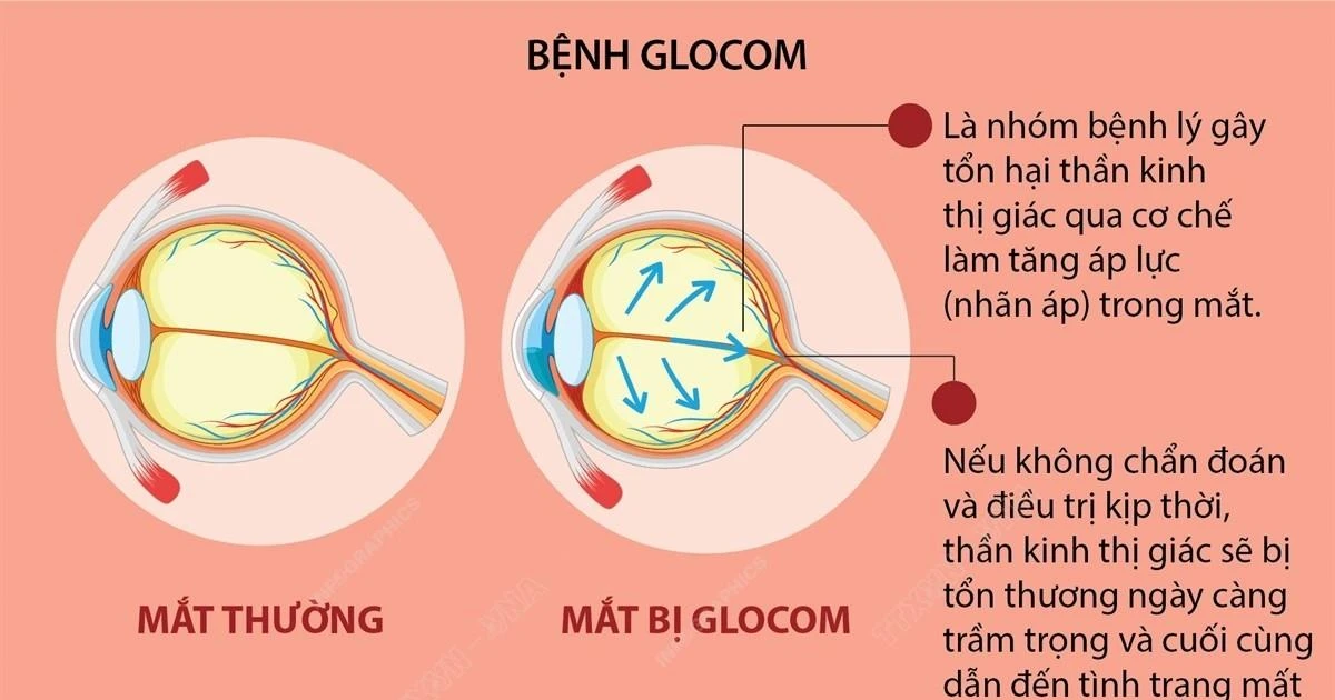 [Infographics] Tuần lễ Glocom Thế giới: Tầm soát và phát hiện bệnh sớm ...