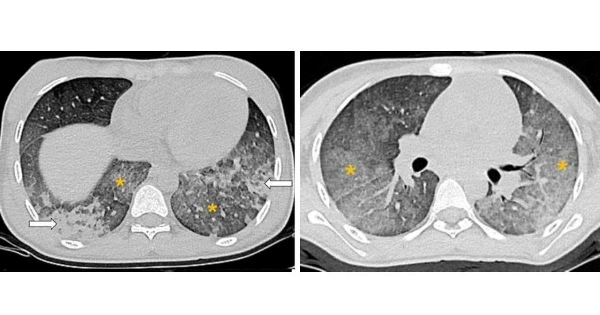 Cứu sống bệnh nhi 14 tuổi mắc Lupus ho ra máu nguy kịch | Vietnam+ (VietnamPlus)