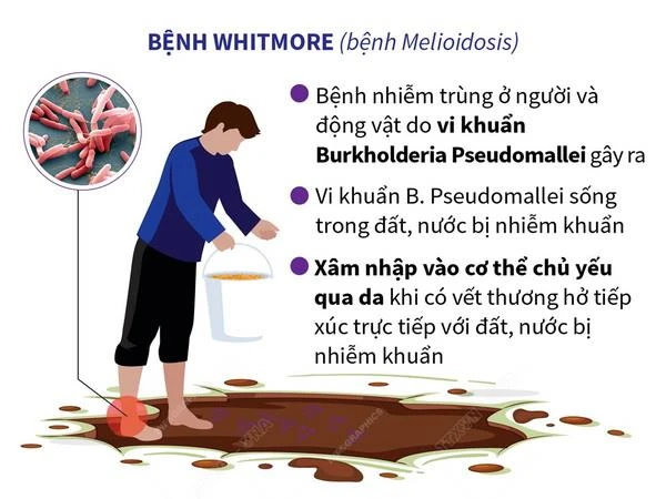 [Infographics] Điều cần biết về bệnh truyền nhiễm nguy hiểm Whitmore ...