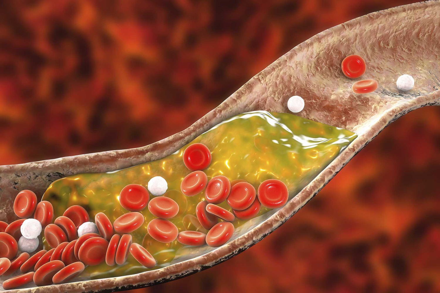 Does nighttime noise pollution affect cholesterol and cardiovascular ...